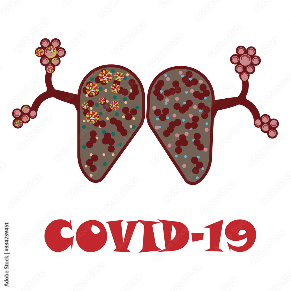 Human lungs. Covid-19. Sars disease, coronaviruses in the lung. The ...