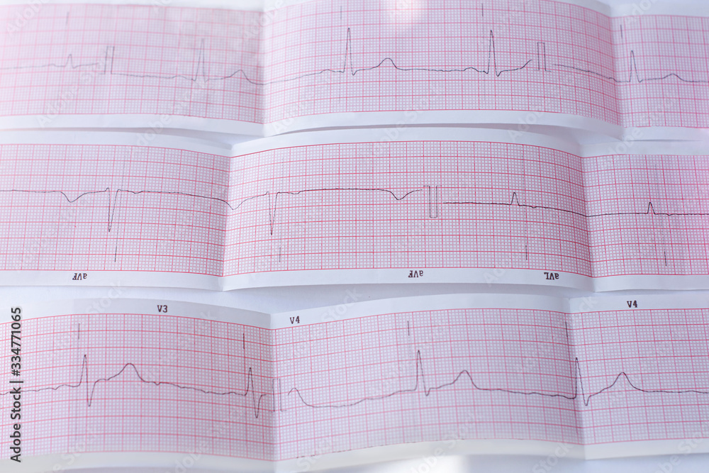 Cardiogram of young person. ECG diagram paper, medical examination ...