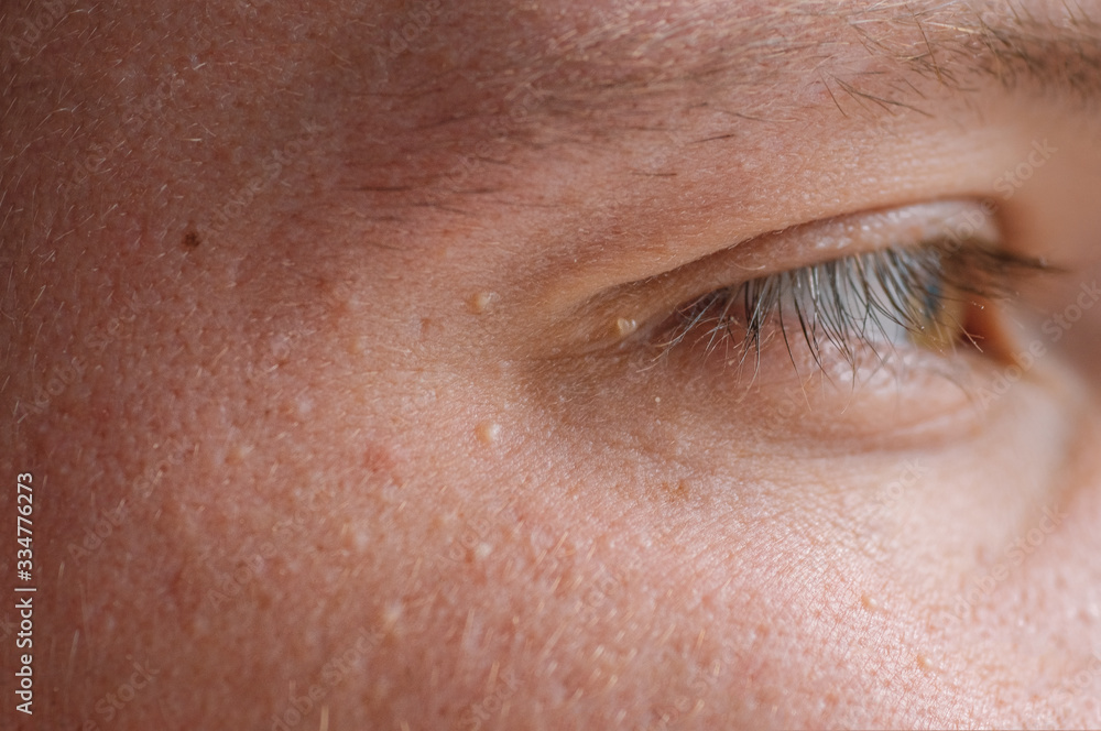 Milia (Milium) - pimples around eye on skin. Eyes of young man with ...