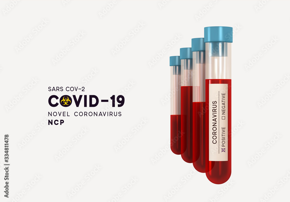 Laboratory blood test for virus Covid19. Novel Coronavirus (2019-nCoV ...