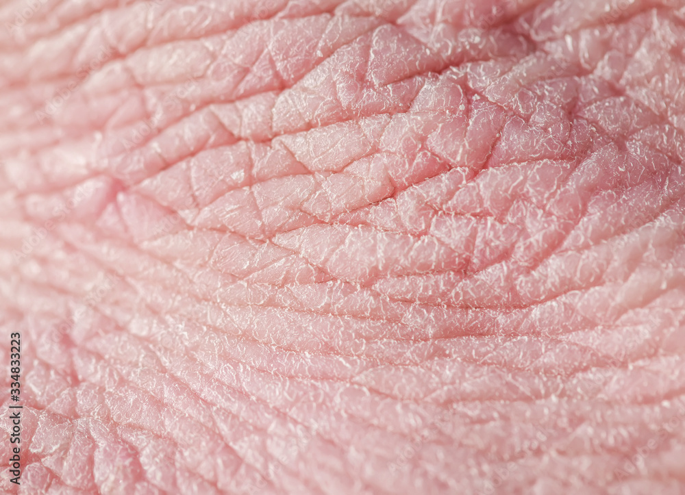 human skin texture covered with deep wrinkles and dry scales Stock ...