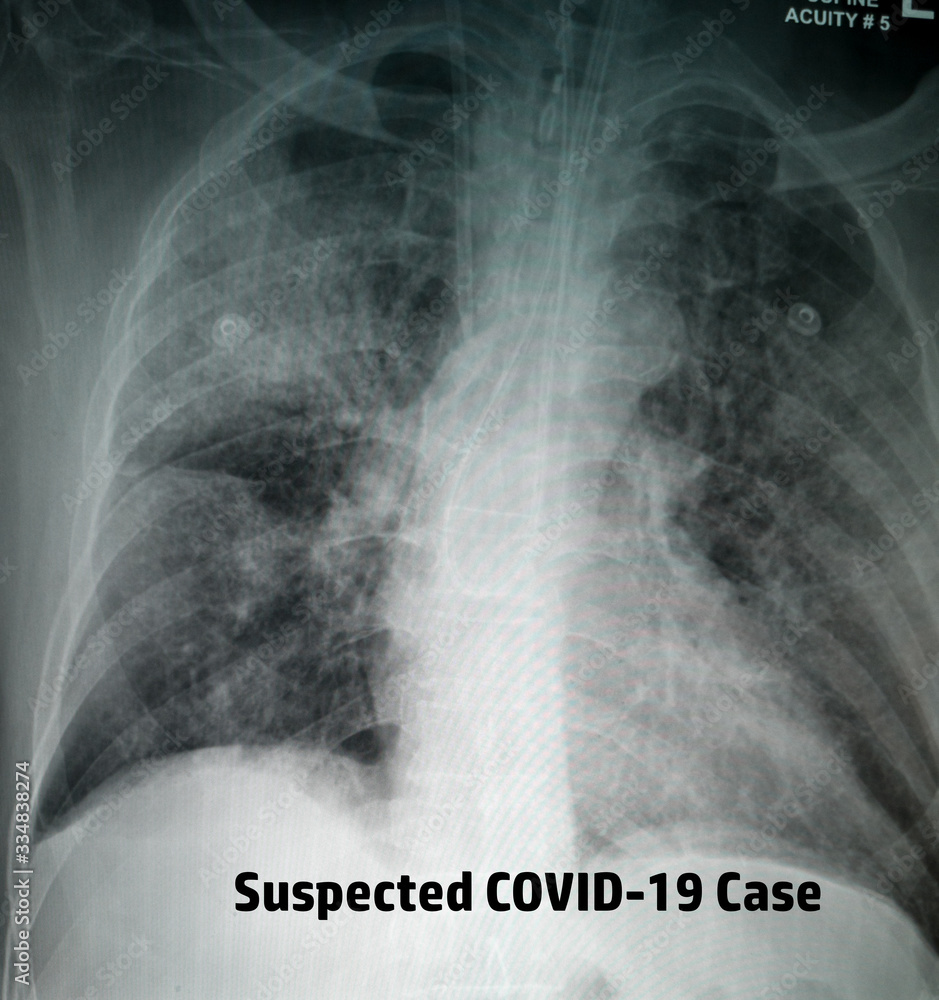 Chest X-Ray of suspected Corona virus patient high quality image showing changes in the lung due ...