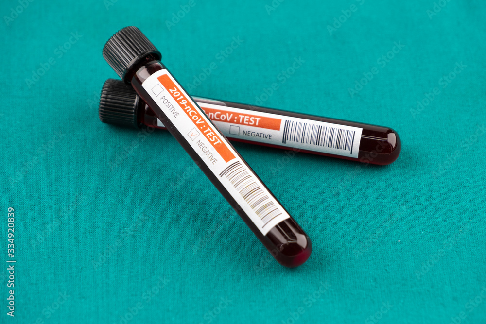 Test tube with blood sample in lab for COVID-19 test on surgical green ...