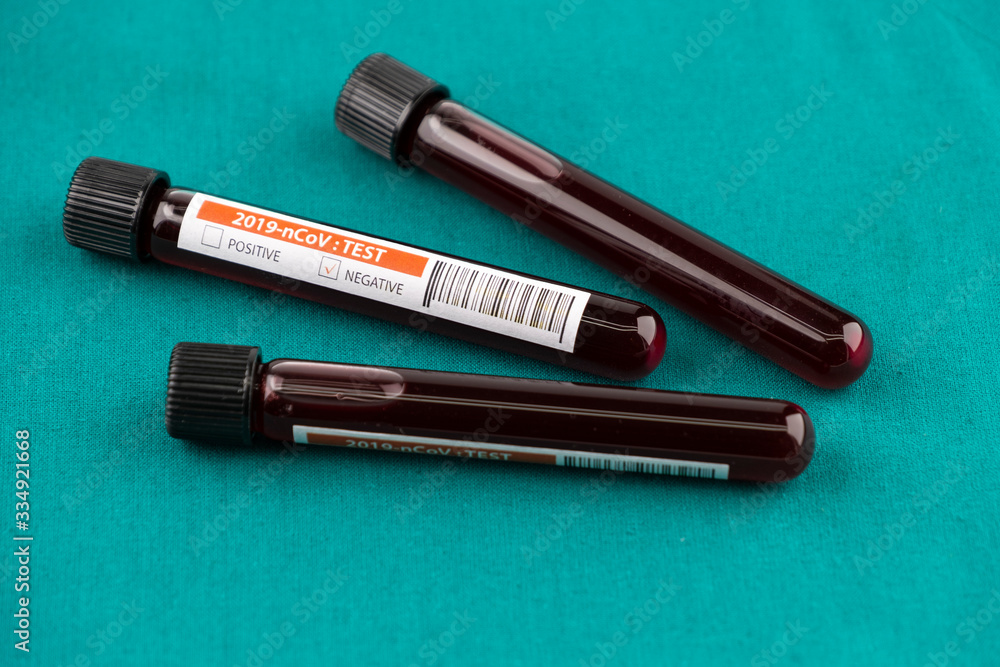 Test tube with blood sample in lab for COVID-19 test on surgical green ...