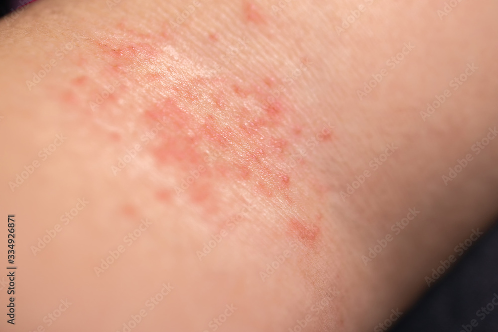 Skin allergic to chemicals causing a rash on the arms, legs, neck and ...