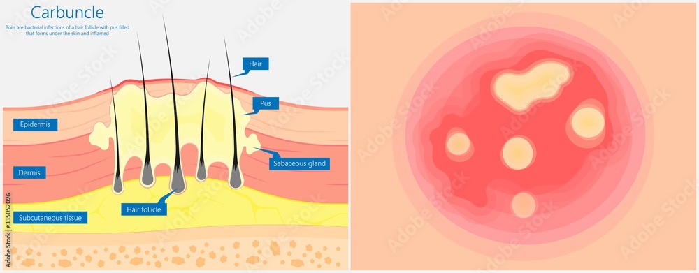 Carbuncle Boils bacterial infection under skin hair follicle pus head ...