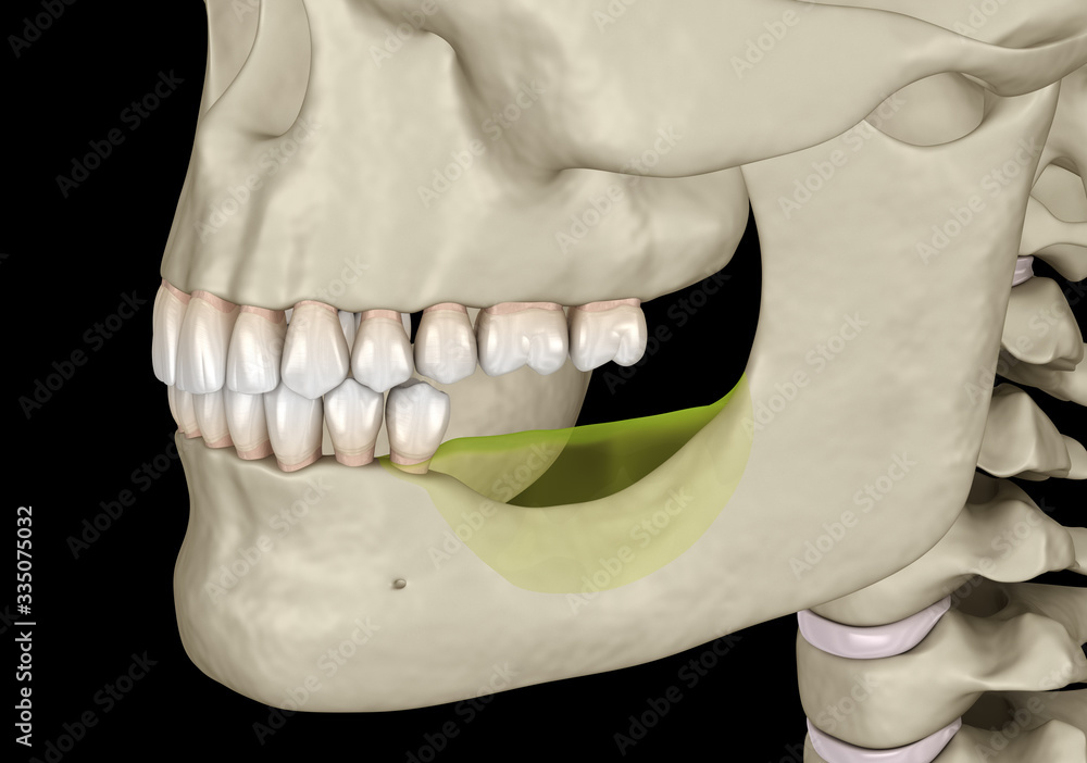 Mandibular Jaw, bone recession after losing molars teeth. Medically ...
