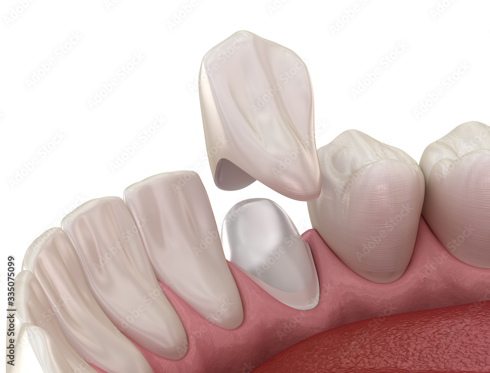 Stump pin tab on canaine tooth. Medically accurate dental 3D ...