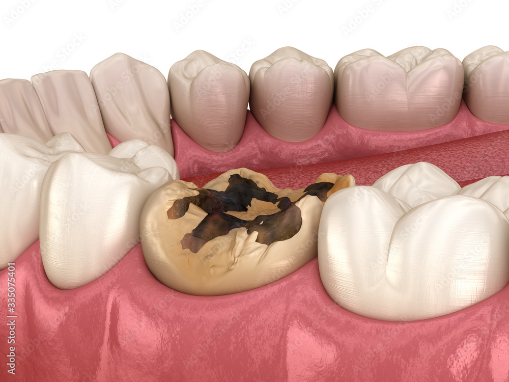 Caries removing process. Medically accurate tooth 3D illustration ...