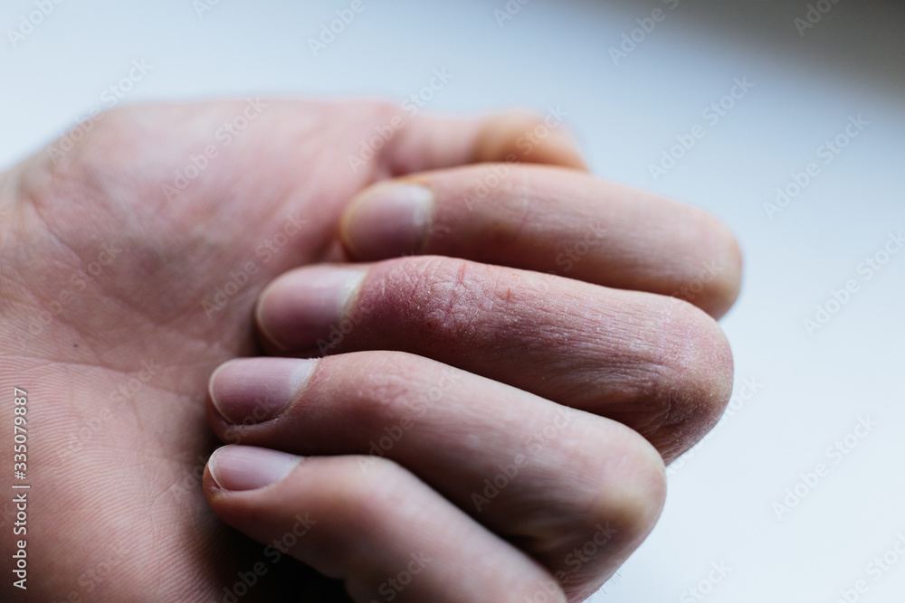 Man with sick hands, dry flaky skin on his hand with vulgar psoriasis ...