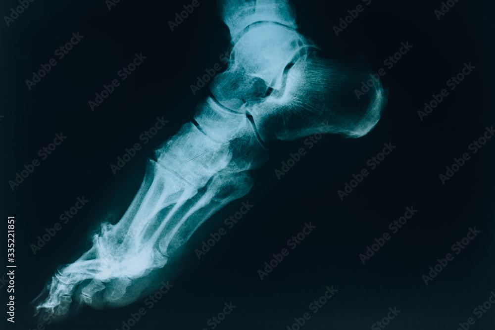 X-ray of the foot. Human bones. Real x-ray leg, side view. Stock Photo ...