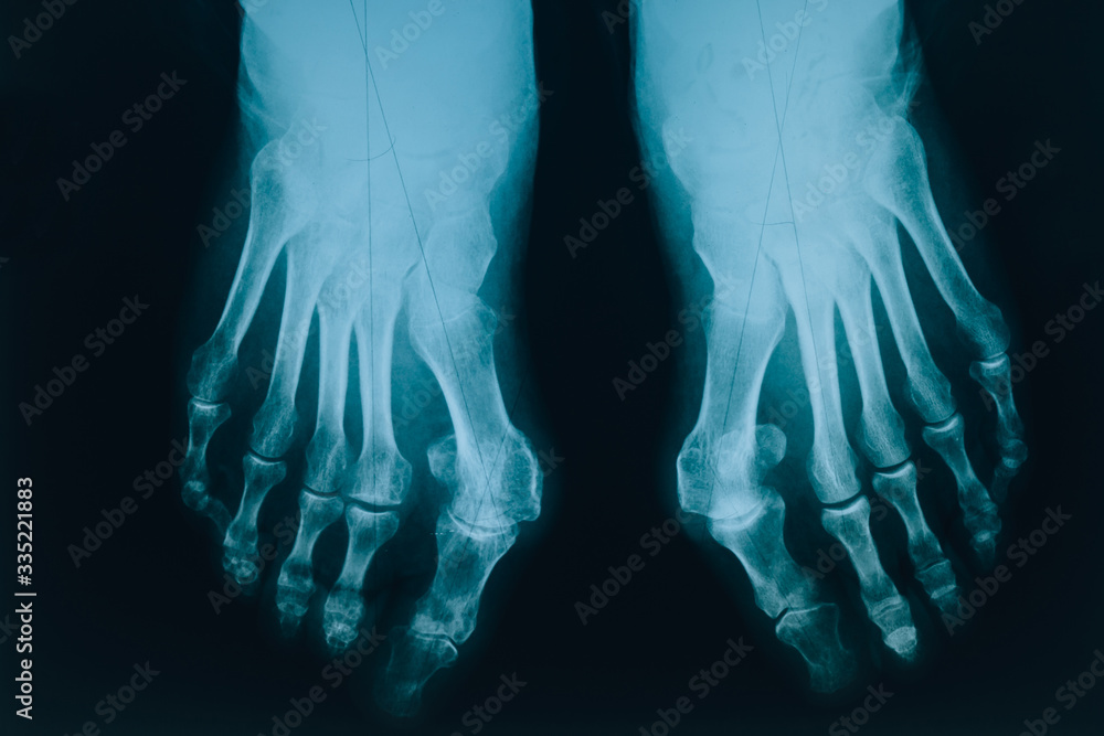 X-ray two feet. X-ray of two sick legs close-up. Human bones. At the ...