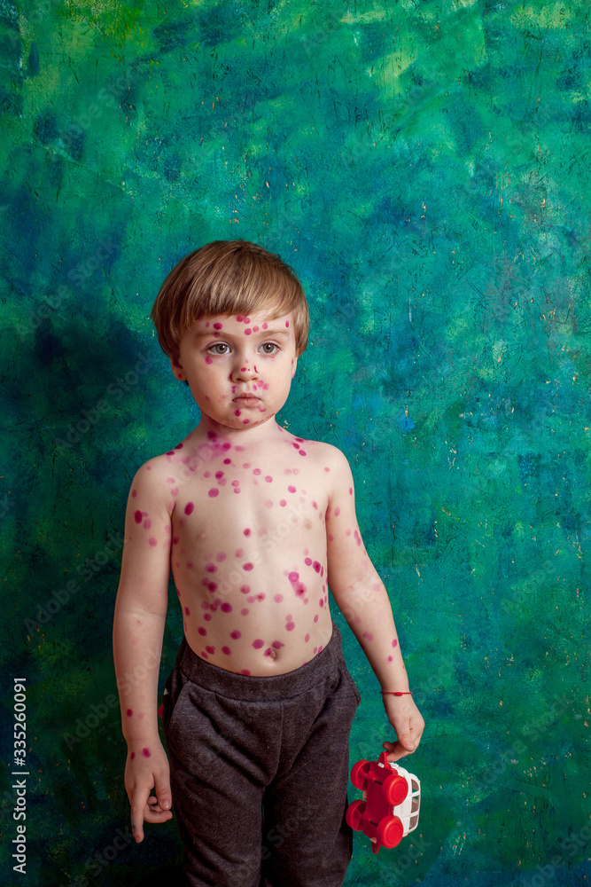 ,boy with chickenpox. Sick child with chickenpox. Varicella virus or ...