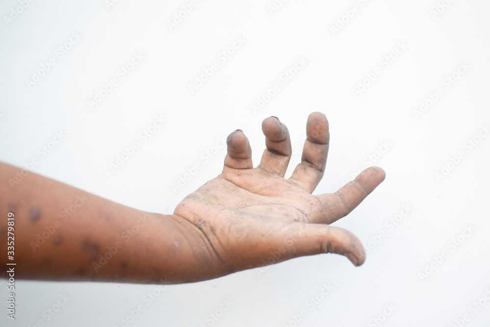 Trigger Finger a defect in a tendon causing a finger to jerk or snap ...