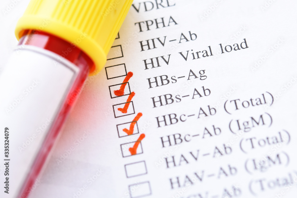 Blood sample tube with laboratory requisition form for hepatitis B ...