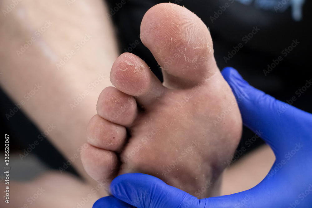 Fungus on the leg close-up isolated on a white background. The concept ...