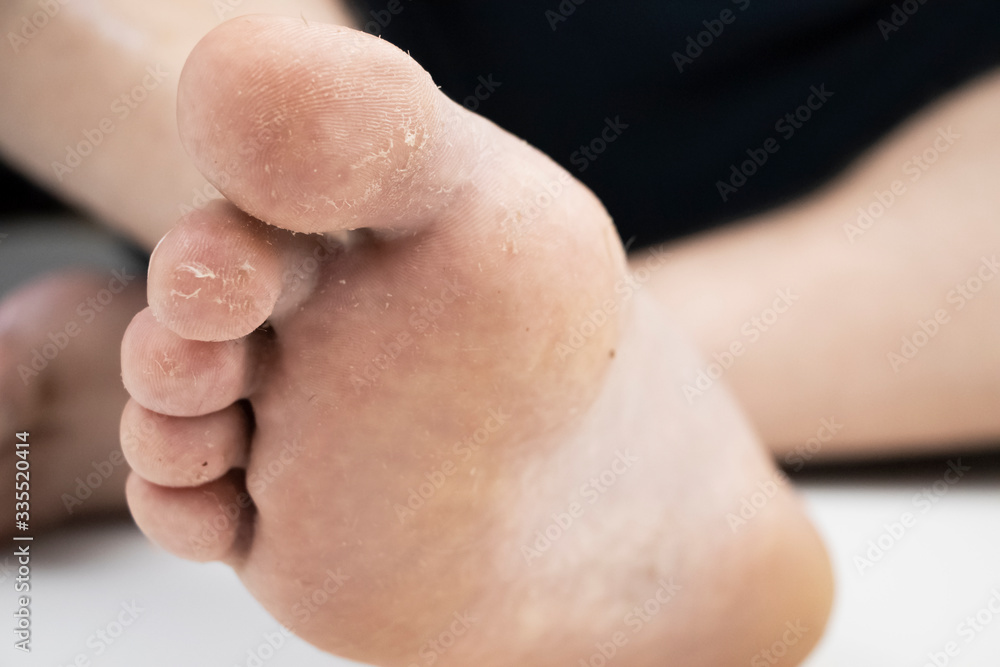 Fungus on the leg close-up isolated on a white background. The concept ...