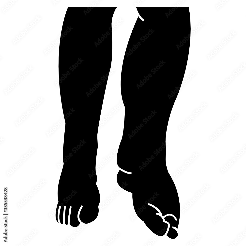 Swollen of the foot, ankle and leg concept vector icon design, swelling ...