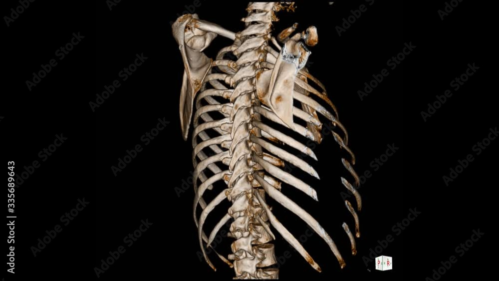 CT Scan Thoracic spine ct with 3D reconstruction . The film shown ...