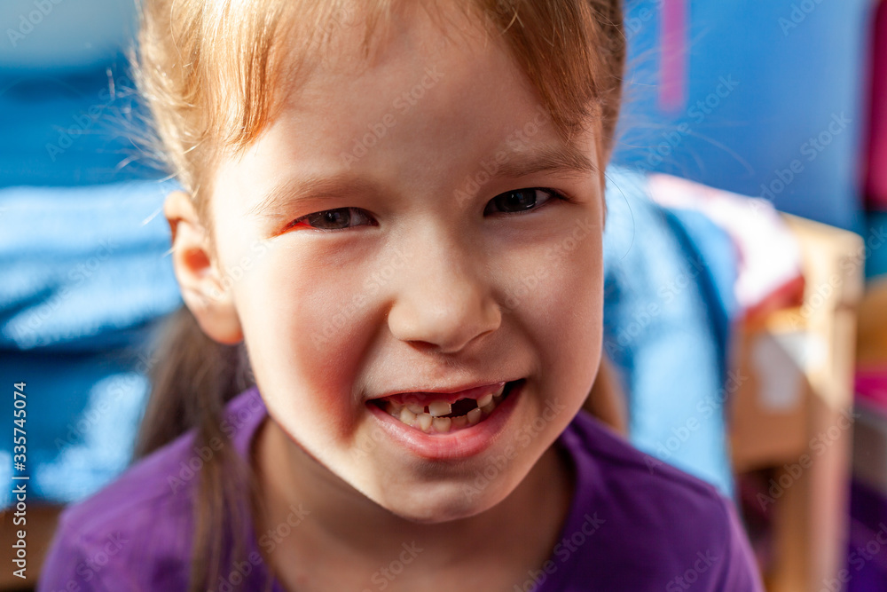 Smiling little girl missing a tooth with her mouth open showing teeth ...