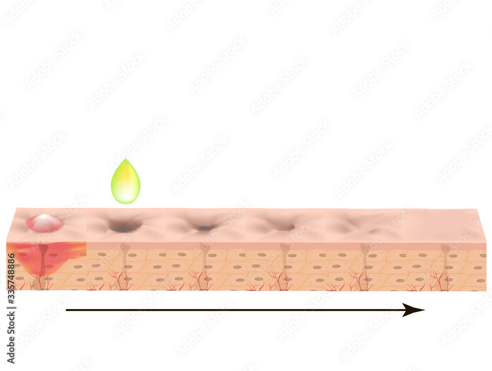 Atrophic scars. Acne scar. The anatomical structure of the skin with ...