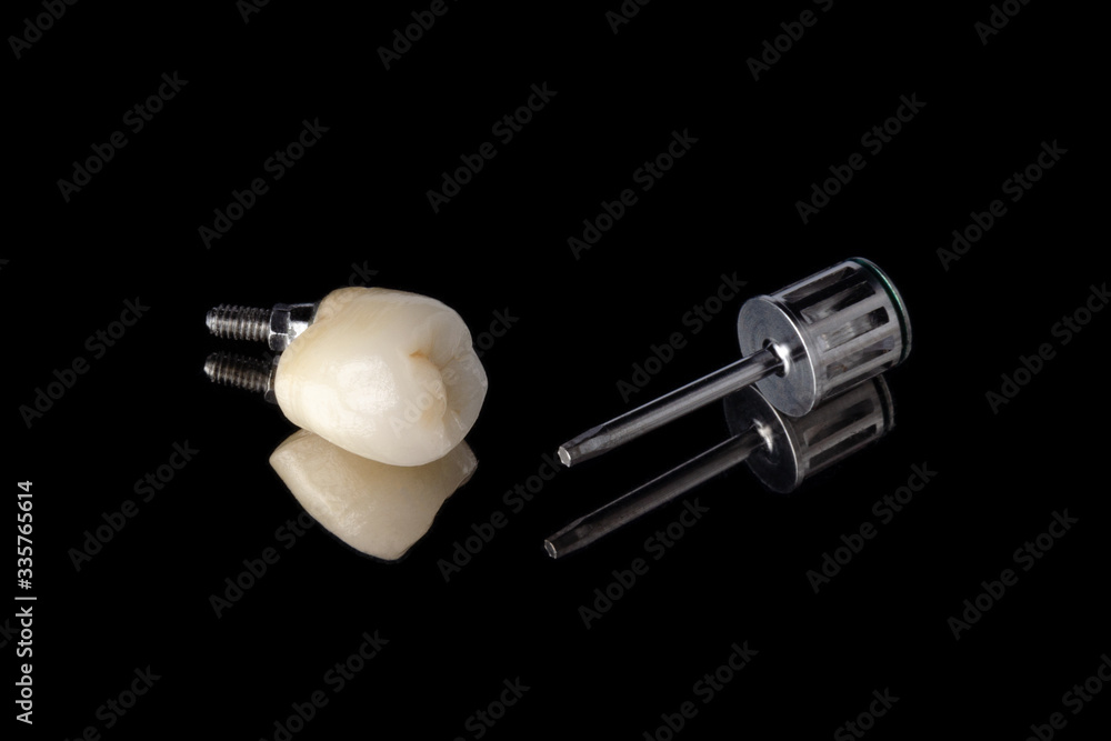ceramic tooth on the implant with pronounced anatomy and a metal ...