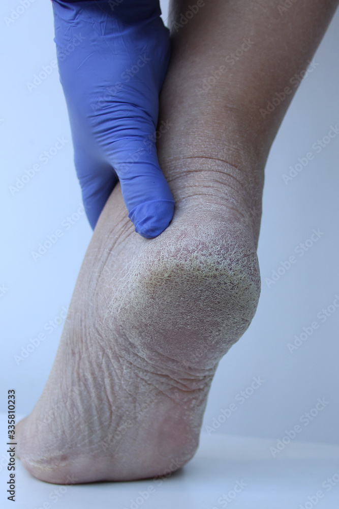 close-up of the foot with damage to dry skin, exfoliation of the ...