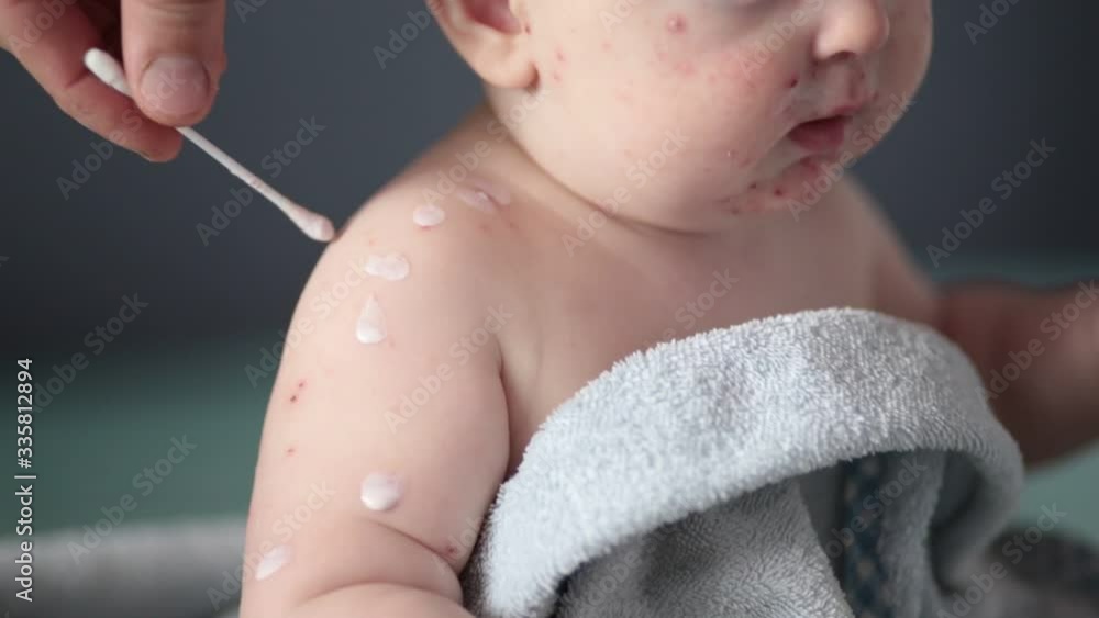 A little sad boy with chickenpox.The child has a lot of blisters and ...