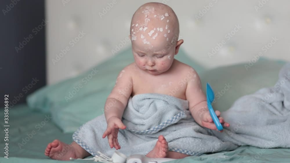 chicken pox varicella disease of child face portrait . Stock Video ...