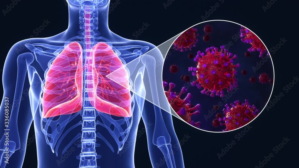 Stockvideon Medical animation of SARS-CoV-2 coronavirus infected lungs ...