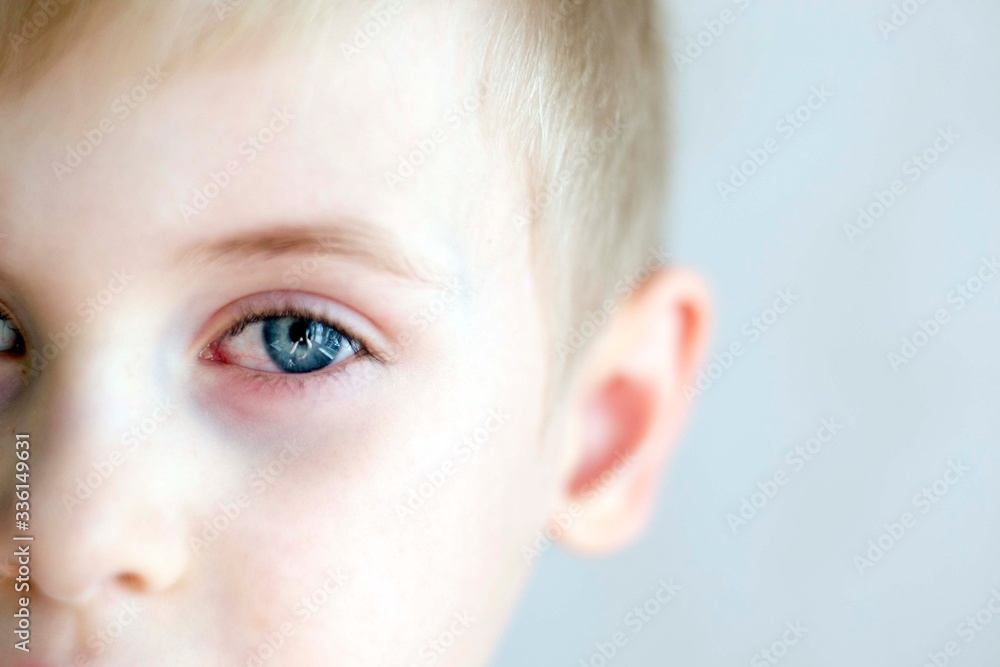 Eye of infant with inflammation of the cornea of the eye. Blond boy ...