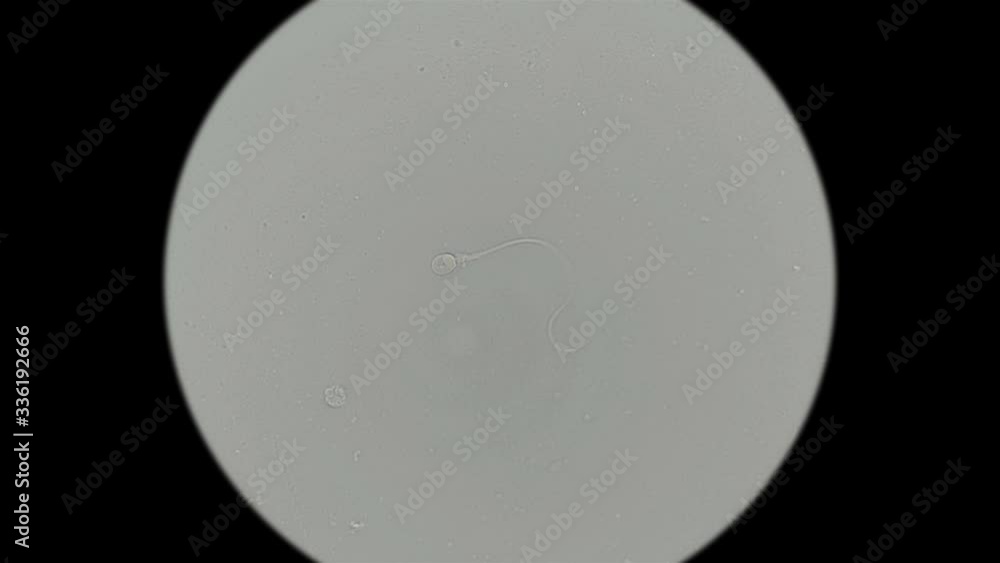 Human sperm under a microscope (spermatozoa), consists of sperm and ...