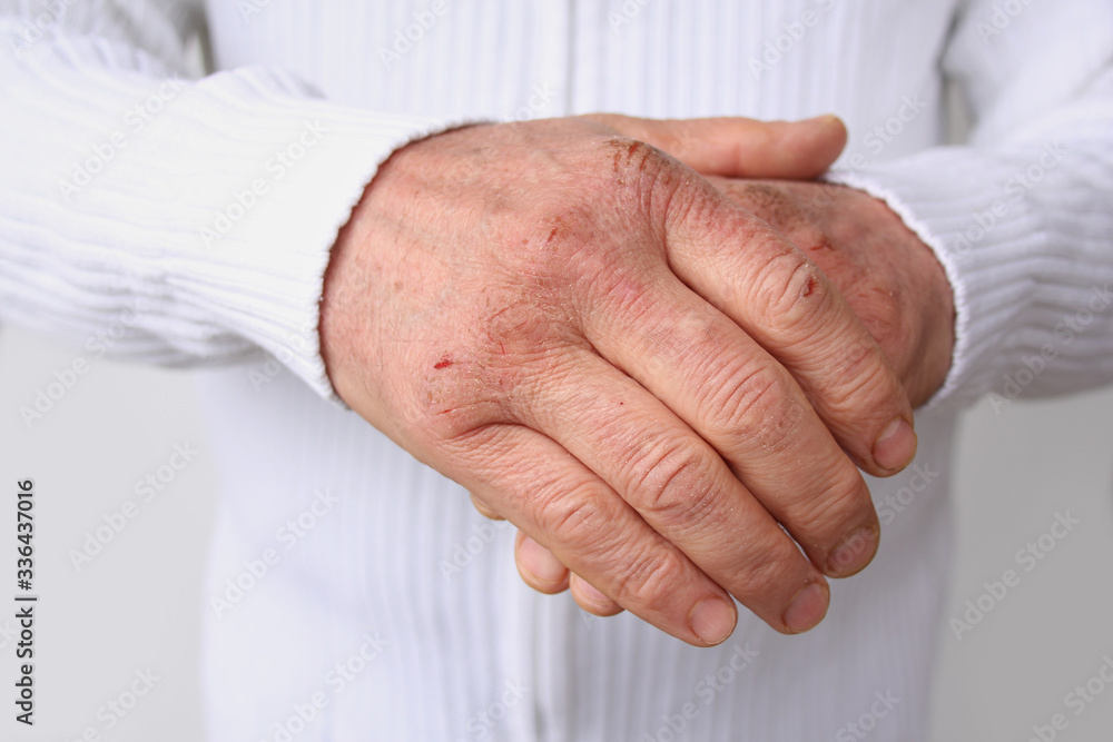 Close up of male hands with dry skin damage. Dermatology concept human ...