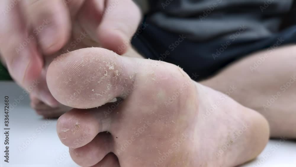 Vidéo Stock Fungus on the leg close-up isolated on a white background ...