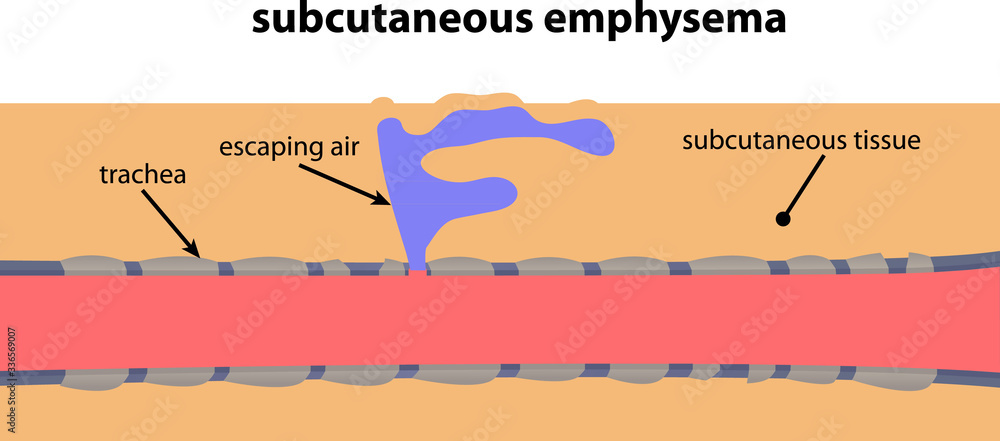 Photo subcutaneous emphysema close up lung, Gregory | Posters, tableaux ...