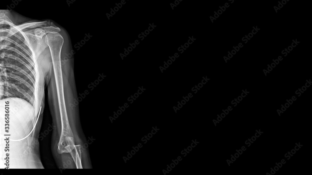 Film X ray elbow radiograph show elbow dislocation. Joint dislocation ...