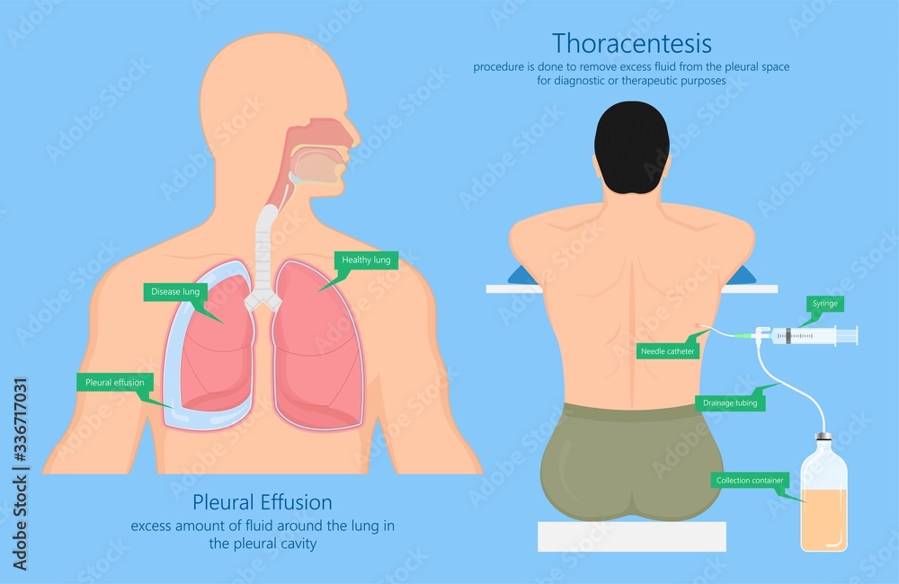 Naklejka VATS lung cancer treatment sub pus tap cell open tube COPD ...