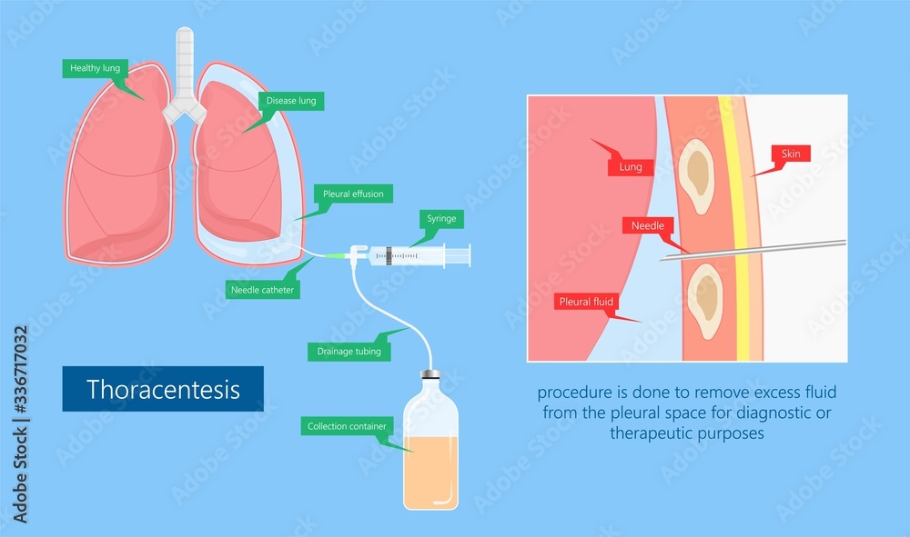 Naklejka VATS lung cancer treatment sub pus tap cell open tube COPD ...