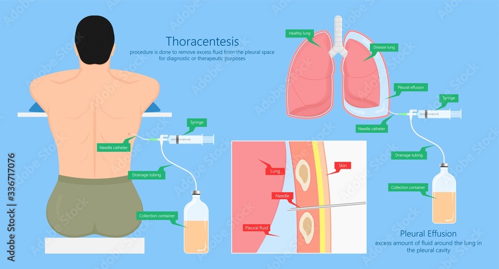 VATS lung cancer treatment sub pus tap cell open tube COPD RATS Wedge ...