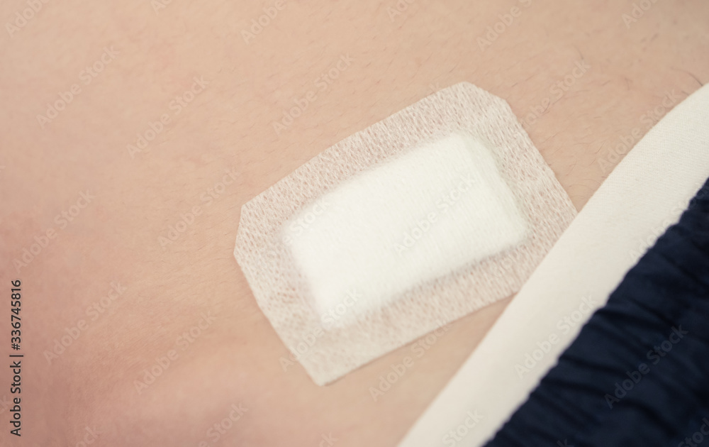 Patched appendix surgical wound after appendectomy surgery, patient ...