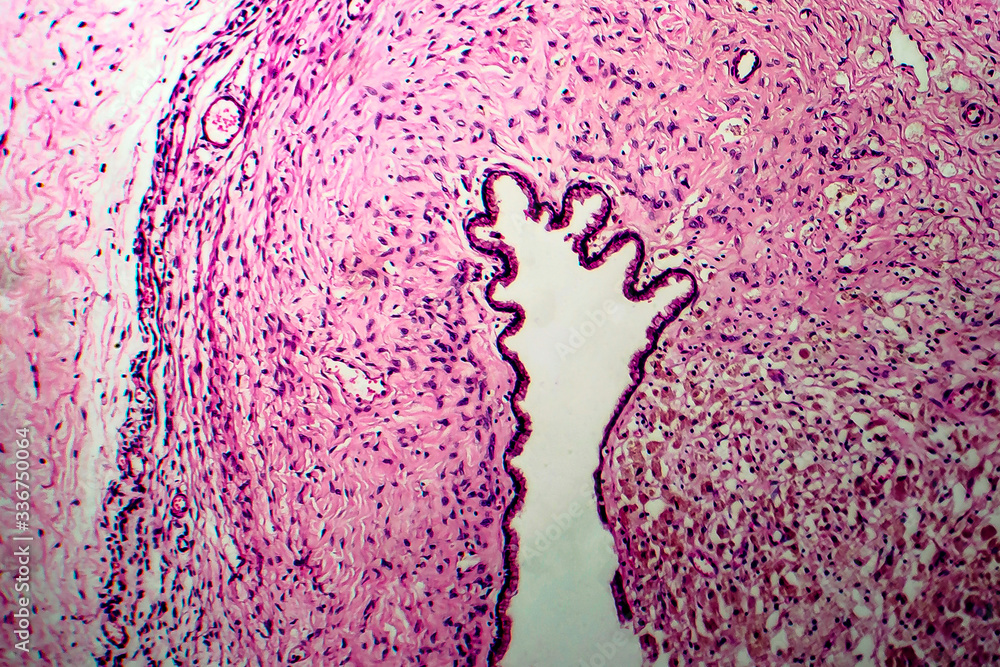 Ovarian cyst, light micrograph, photo under microscope Stock Photo ...