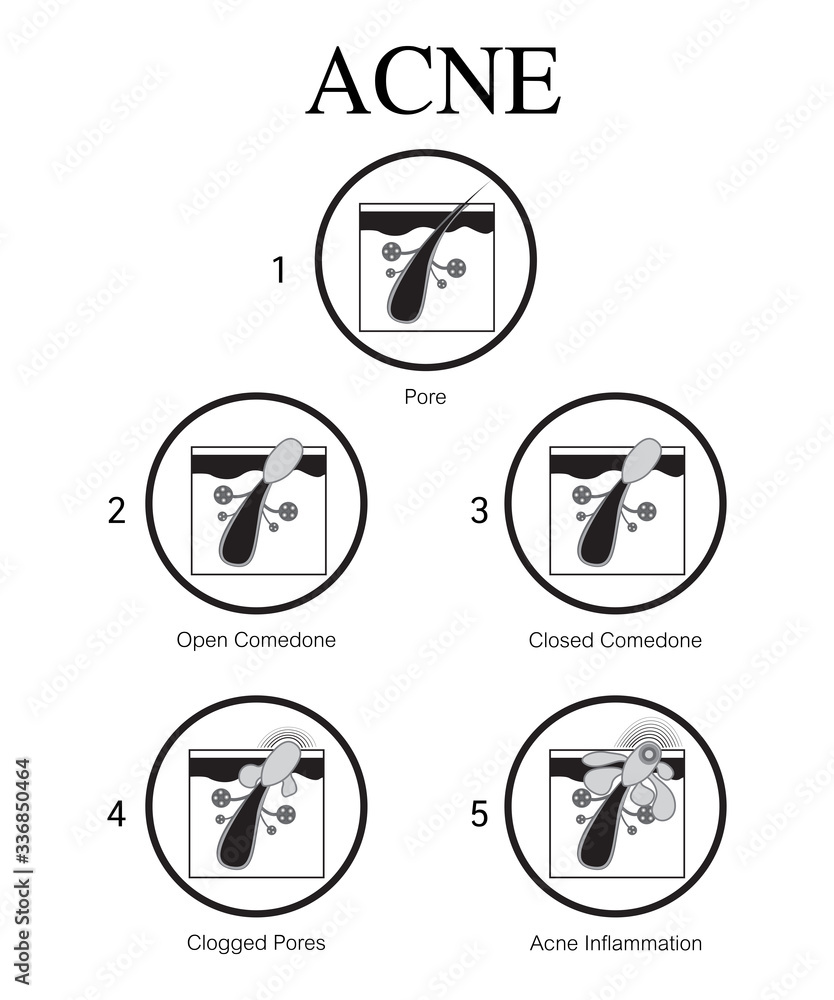 Acne,stages of development,healthy skin,vector design Stock Vector ...