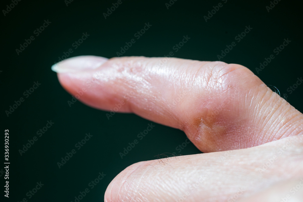 Foto de The right little finger, recovering from a dislocation rupture ...