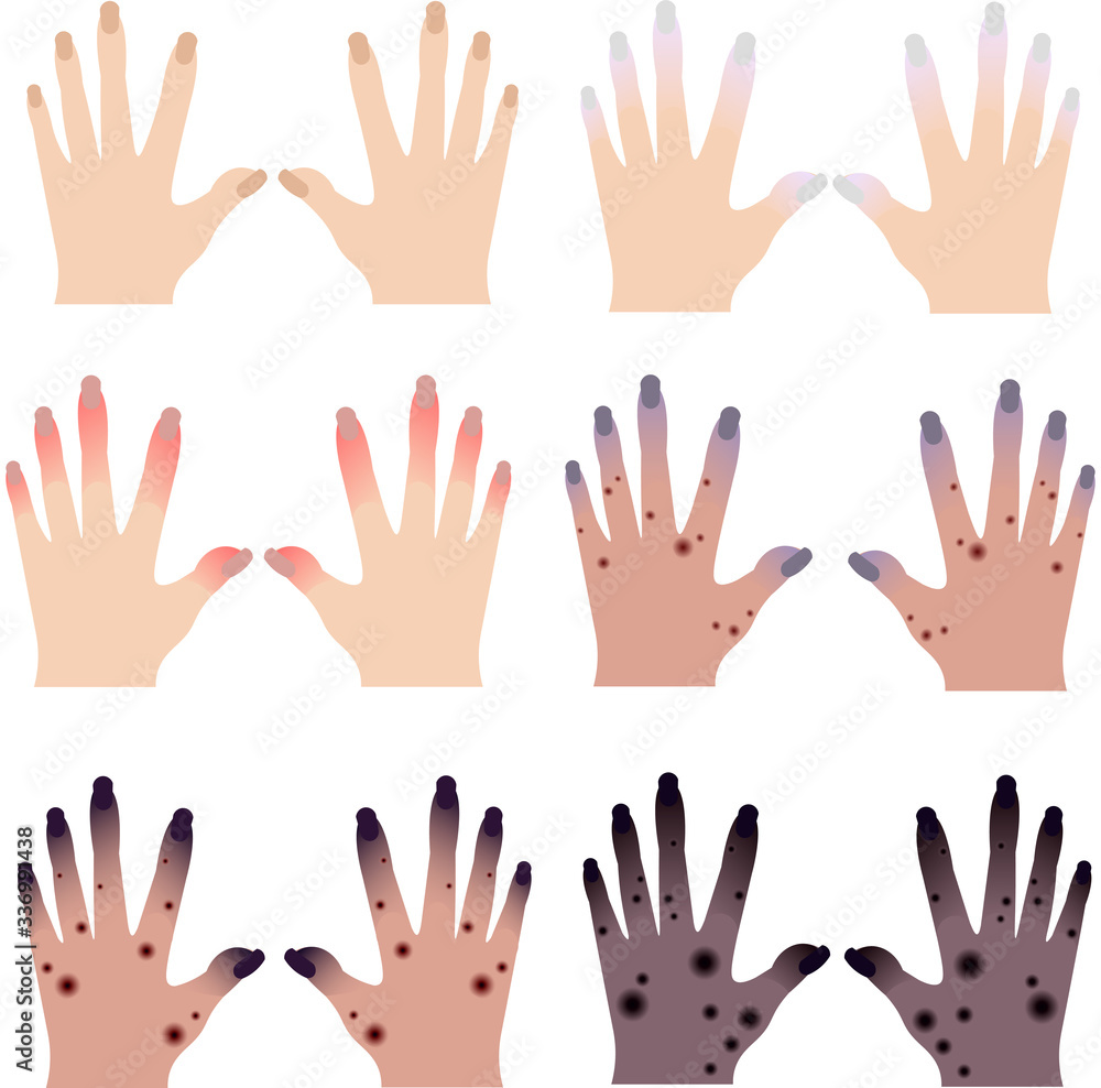 Sore hands. Skin diseases. Ulcers and rashes. Gangrene and necrosis ...