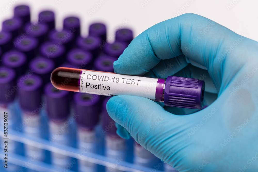 Positive COVID-19 test tube and laboratory sample of blood testing for ...