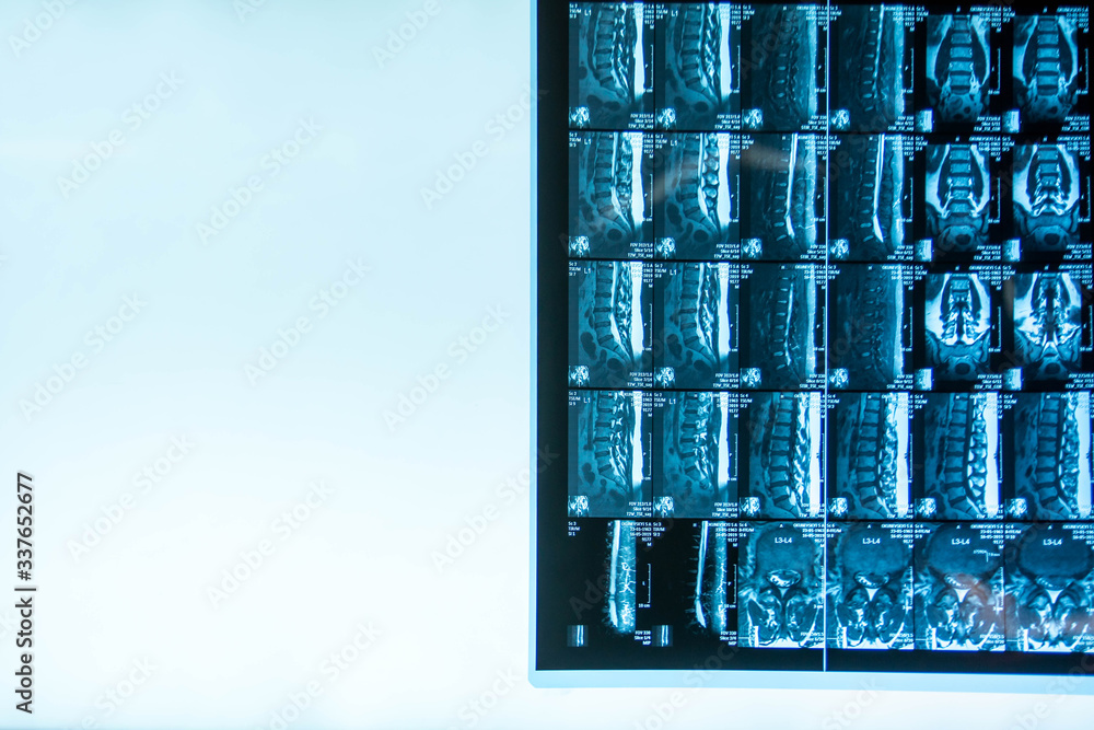 X-ray negative image of the human spine on a negatoscope. Stock Photo ...