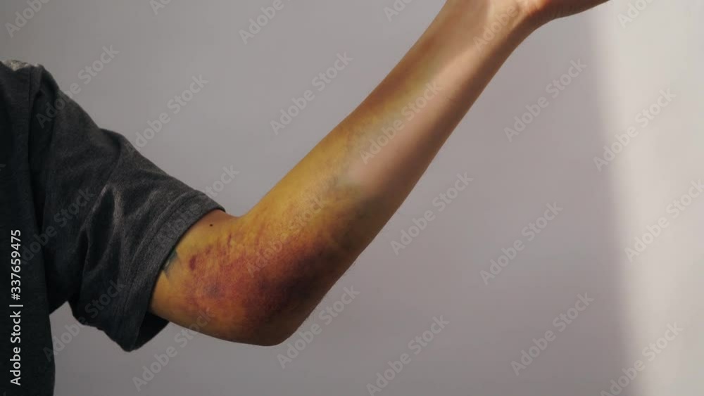 Intense bruising from a dislocated elbow joint and ligament damage on ...