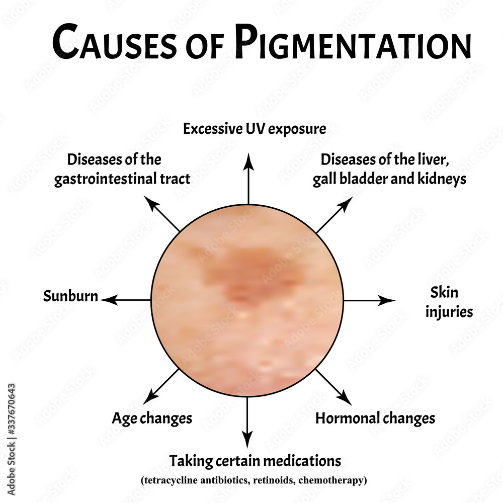 Skin Pigmentation Brown Patches