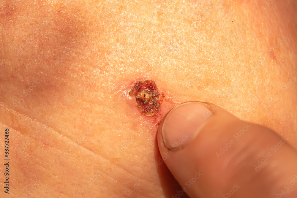 Cauterized wart on the face. Finger points to the scar after removing ...