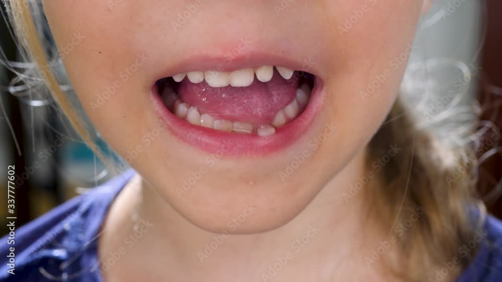 Little girl with wobbly first milk temporary tooth. Dental medicine or ...